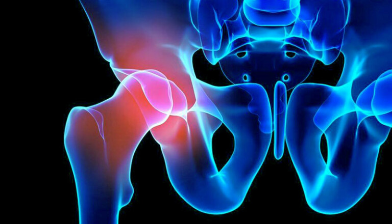 5 Common Causes of Hip Pain in Women - The Art of Healing
